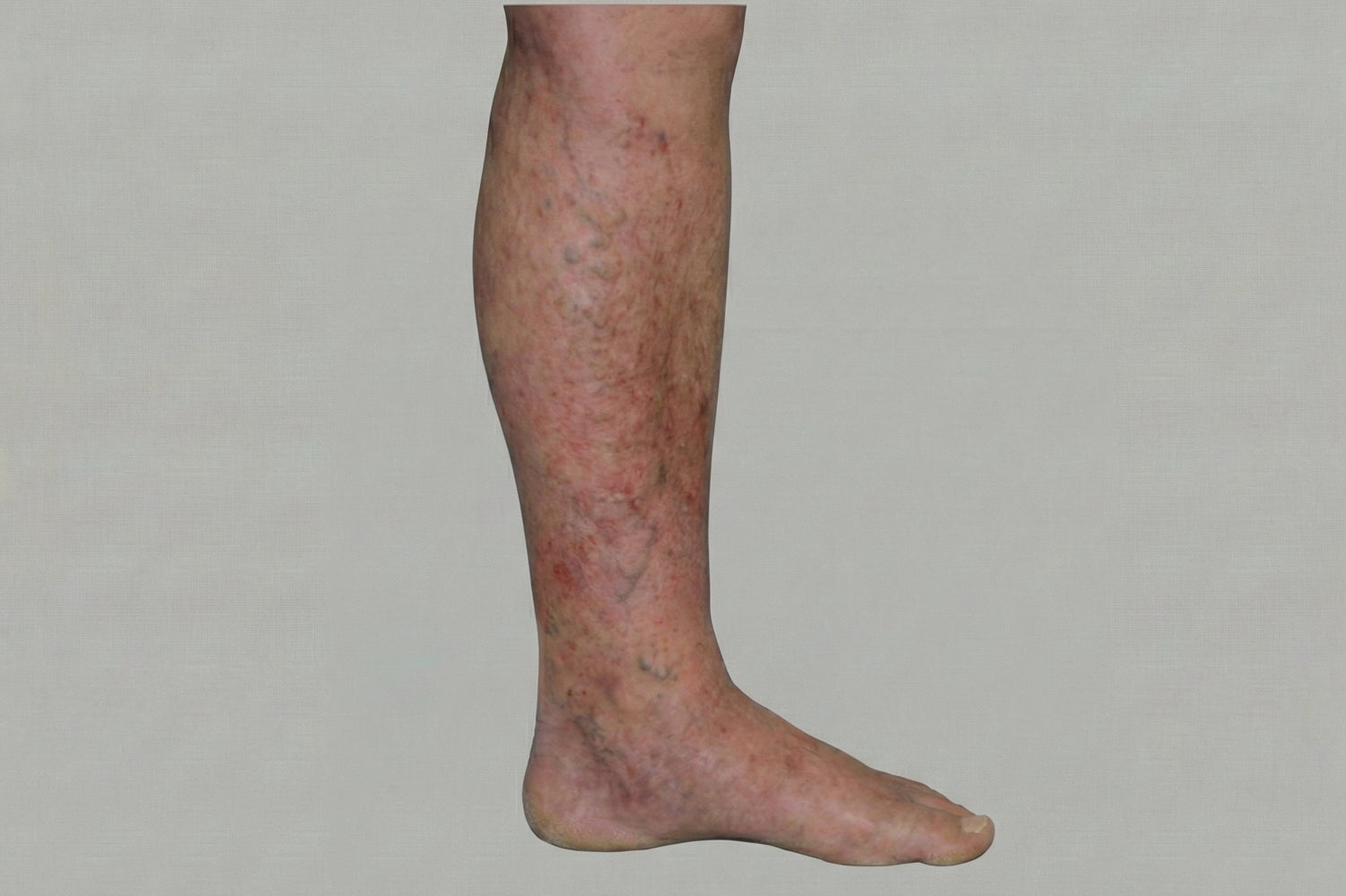 ORNEXIS - EMS TREAT STASIS DERMATITIS FROM HOME – Ornexis